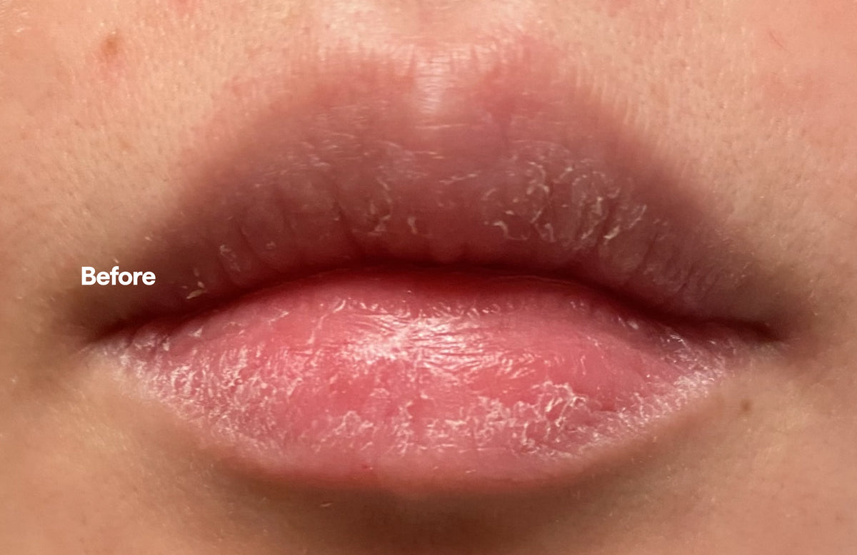 REMEDY for dry lips – Remedy Science by Dr. Muneeb Shah