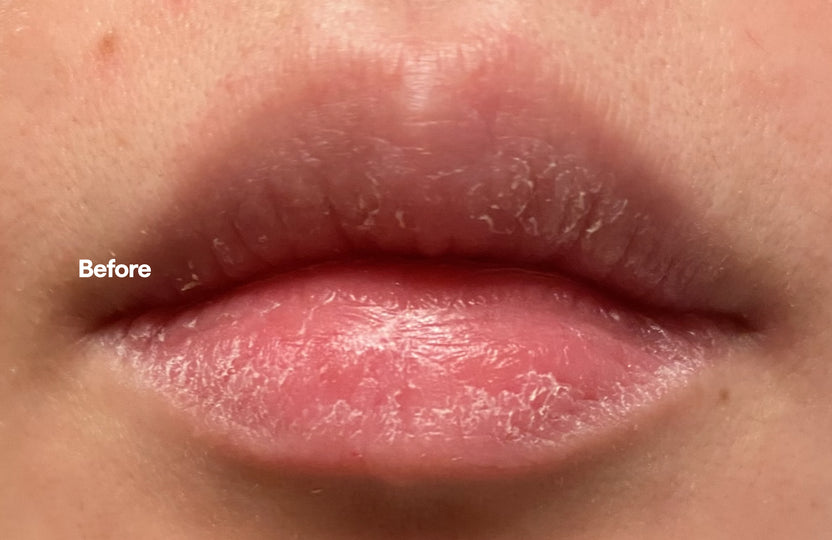 REMEDY for dry lips – Remedy Science by Dr. Muneeb Shah