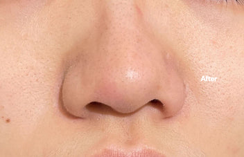 REMEDY for pore size – Remedy Science by Dr. Muneeb Shah