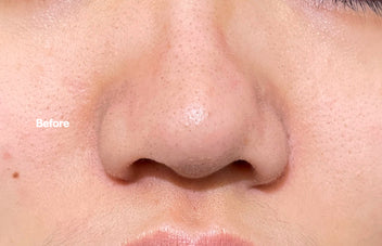 REMEDY for pore size – Remedy Science by Dr. Muneeb Shah